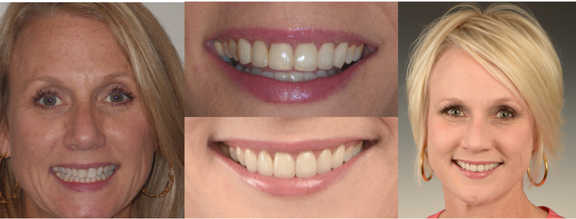Smile Gallery | William Linger, DDS, MAGD