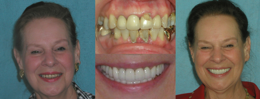 Smile Gallery | William Linger, DDS, MAGD