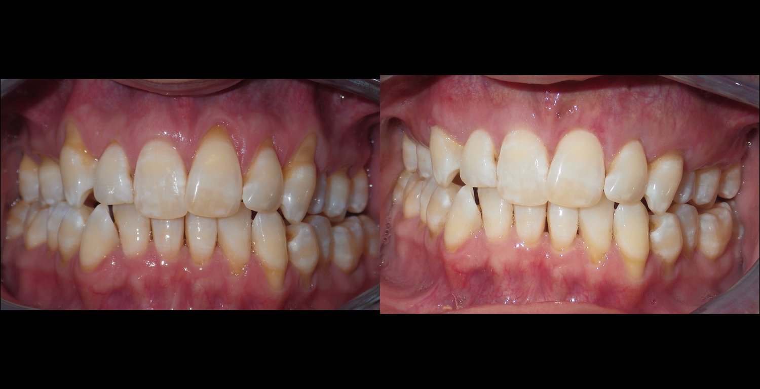 Pinhole Surgical Technique | William Linger, DDS, MAGD