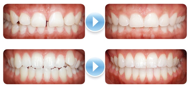 The Biggest Challenges With Veneers