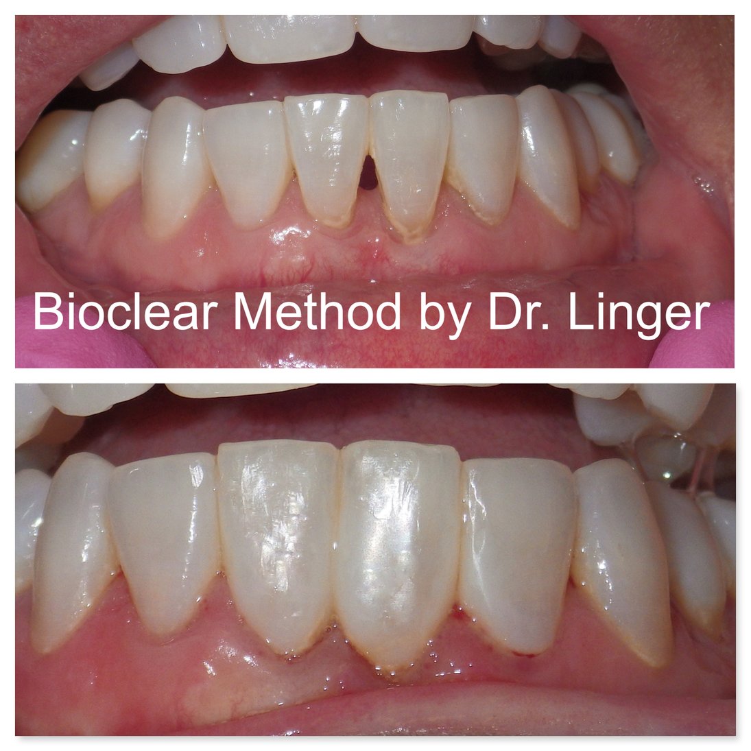 Bioclear Dental Bonding | Charlotte NC | William Linger, DDS, MAGD