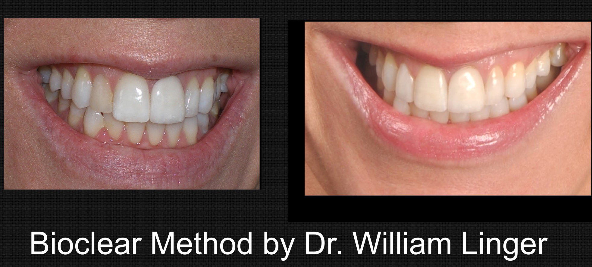 Bioclear Dental Bonding | Charlotte NC | William Linger, DDS, MAGD
