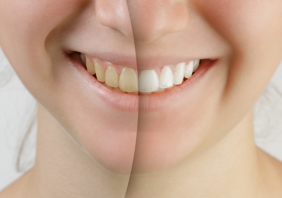 Getting Your Teeth Whitened Before Any Other Cosmetic Dentistry