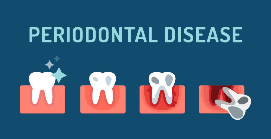 What Is Periodontal Disease And How To Treat It