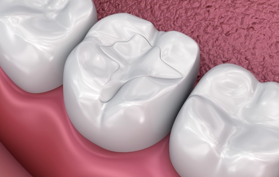 New Methods of Tooth Restoration without Crowns